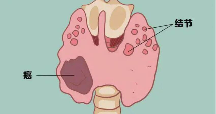 談談甲狀腺結節 - Qoo | FUN01 創作分享