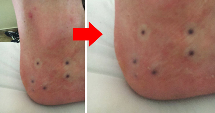 去海裡游泳 他上岸後「腳多了6個洞」！網驚：快去醫院 - Qoo | FUN01 創作分享